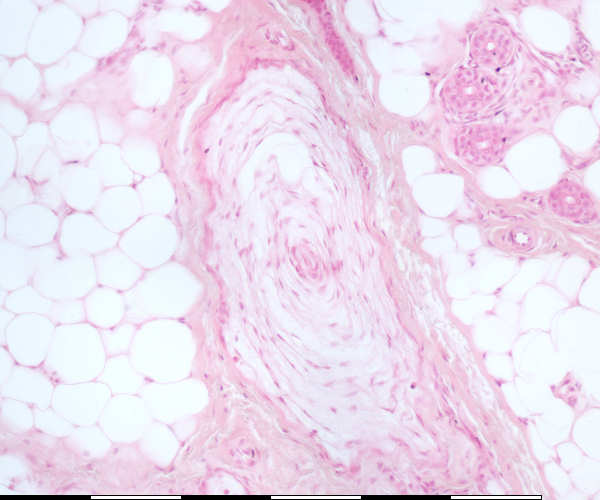 Plaatjie 93: Medium vergroting van die palmare vel: Vater-Pacini liggaampie